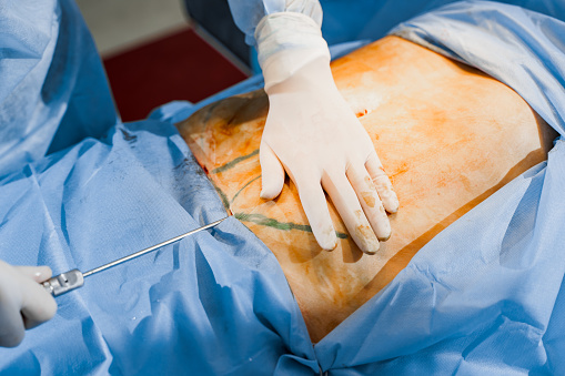 Liposucción y grasa corporal: lo que debes saber sobre su retorno - InfoRD